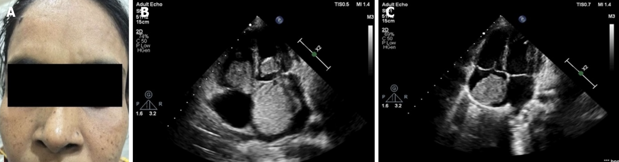 Mixoma cardíaco - DozeNews - Cardiologia pela Doze por Oito