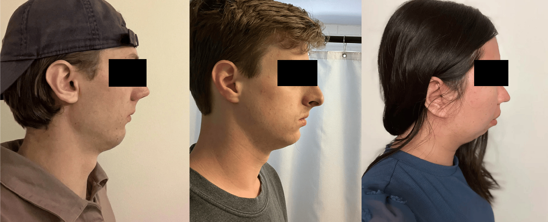 5.1 Intro to MARPE - by Ronald Ead - JawHacks