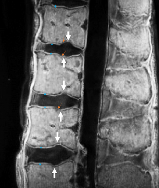 Clinician's Corner | Schmorl's Nodes are Puzzling