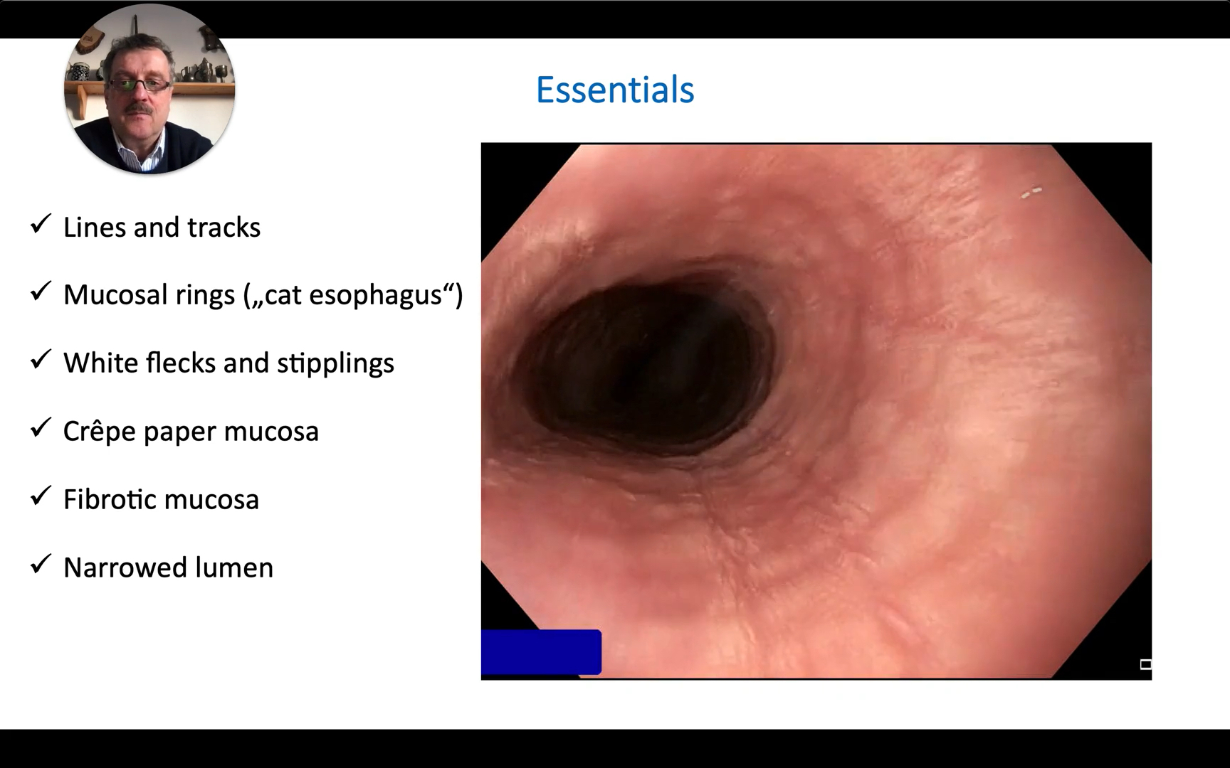 Eosinophilic Esophagitis: Essential Steps for a Correct Diagnosis