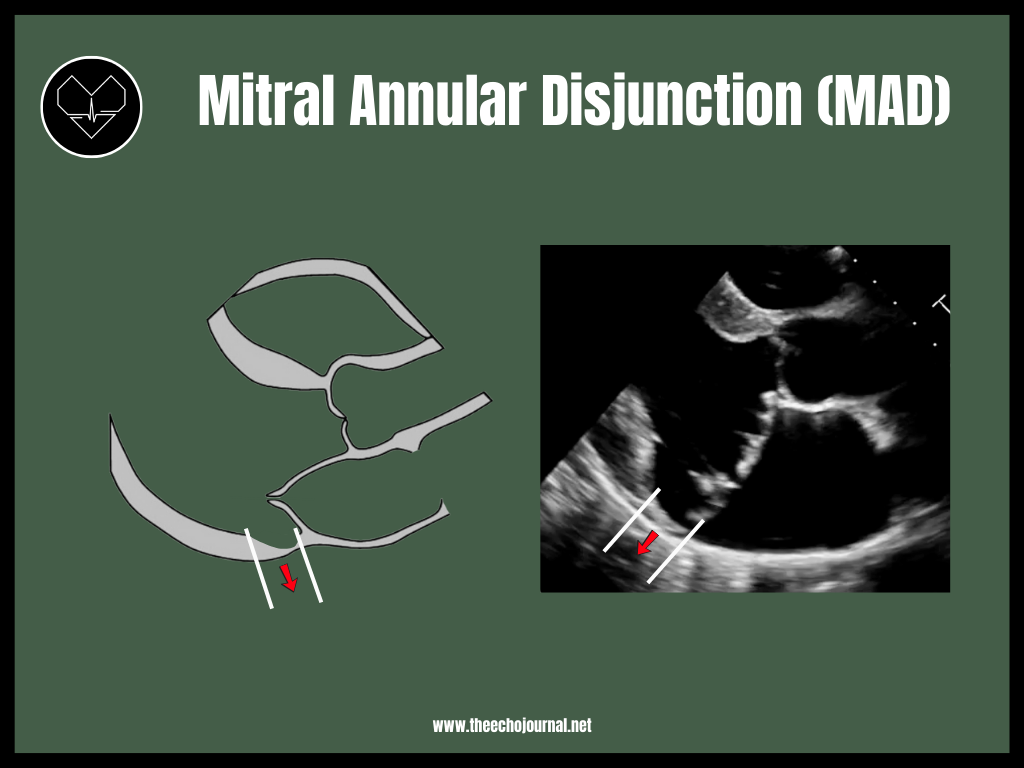 Mitral Annular Disjunction: Findings, Relevance, & Case Breakdown