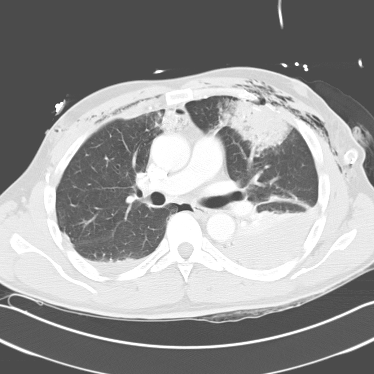 Pulmonary Contusions and Lacerations - by Alexander Baxter