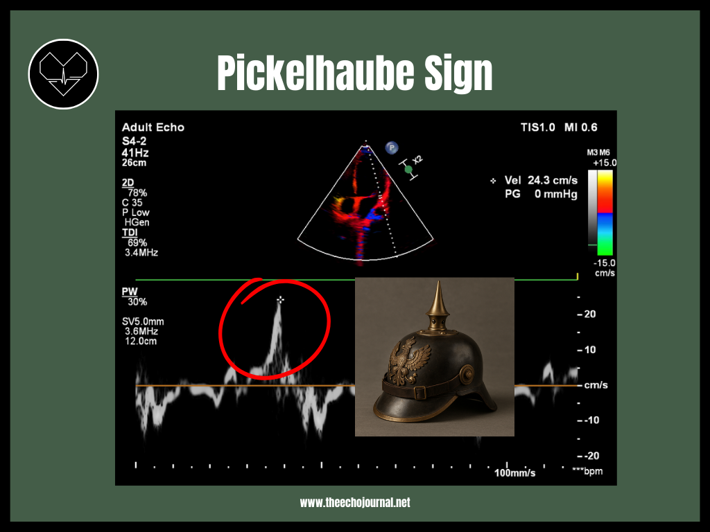 Mitral Annular Disjunction: Findings, Relevance, & Case Breakdown