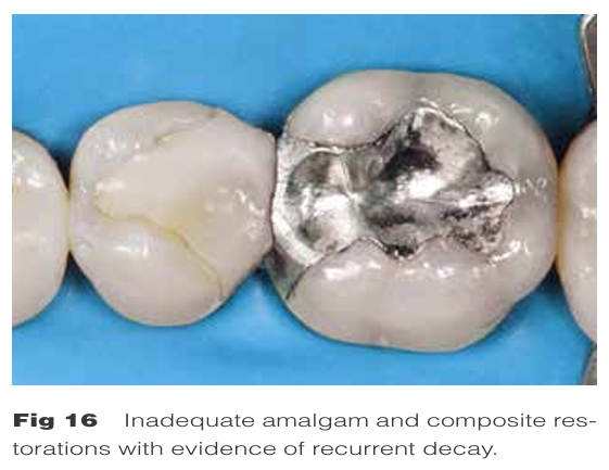 Posterior indirect adhesive restorations: updated indications and the ...