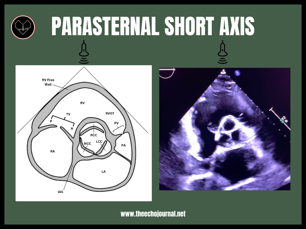 Parasternal Short Axis: Tilting and Rotating - by Alex C.