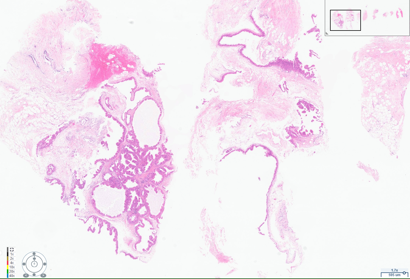 Apocrine Cysts - by Chelsea Mehr, MD - The Path Princess