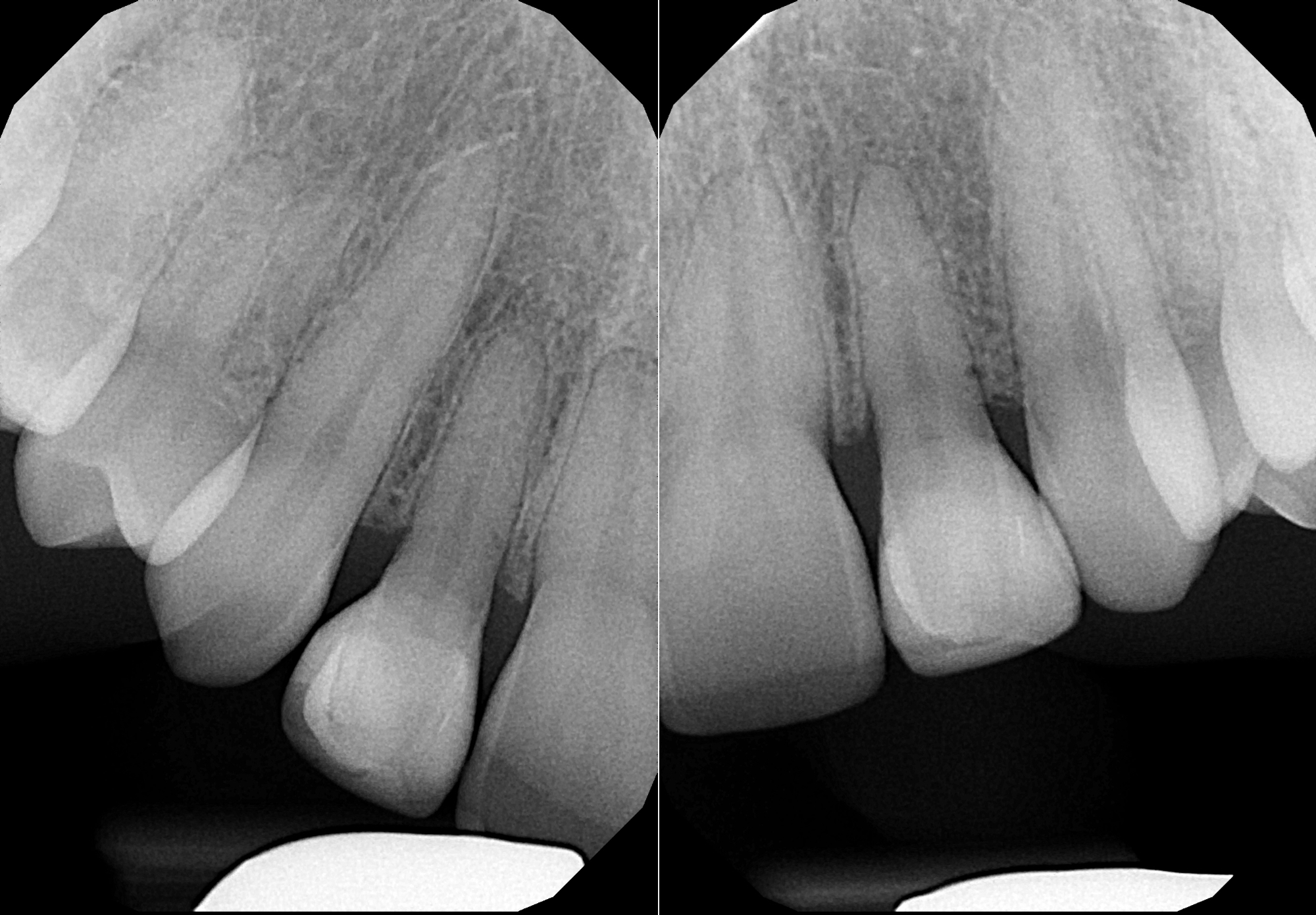 Peg Lateral Rejuvenation - by Brandon Walker, D.D.S.