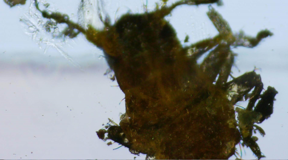 Morgellons Like Filament Tumor Found In Nasal Cavity With Insect ...