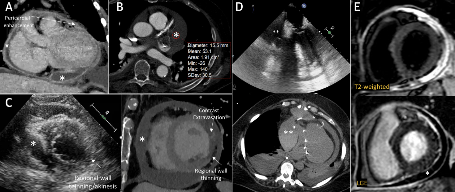 Manejo do Derrame Pericárdico