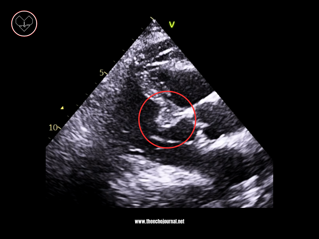 What is a Sigmoid Septum? - The Echo Journal