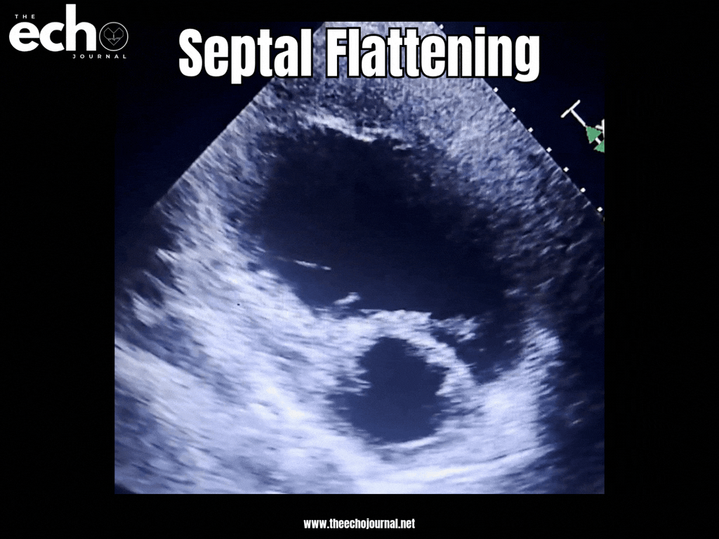 The Displaced Valve: Recognizing Ebstein's Anomaly on Echo