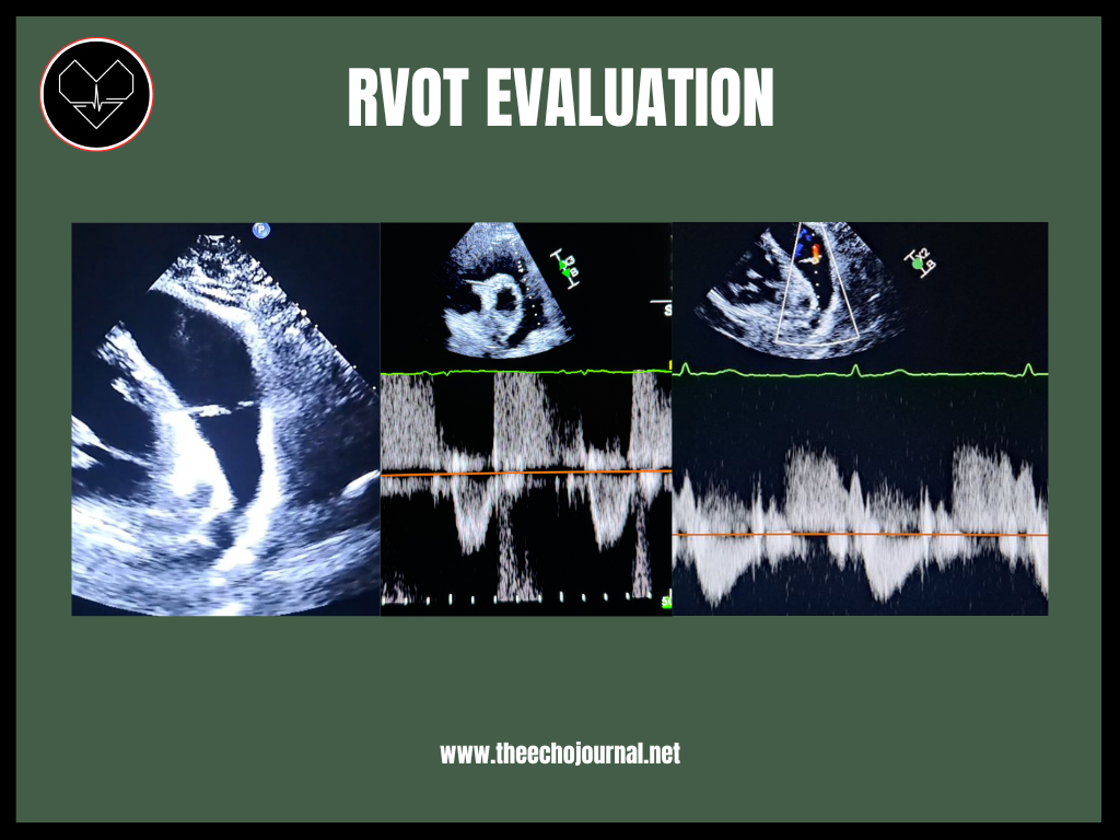 Parasternal Long Axis: What to Acquire and How to Measure