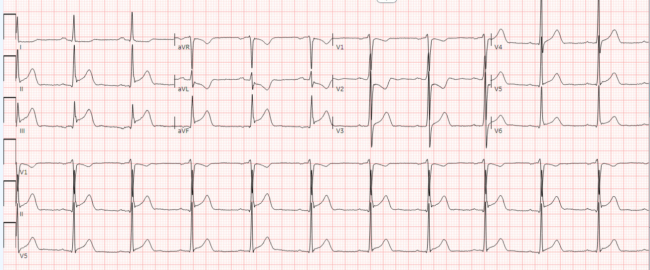 #1 - Knowing What to Expect from an Anterior versus Inferior Wall ...