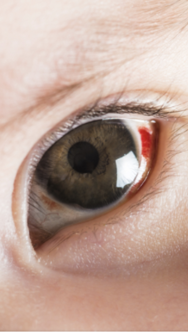 Pediatric Pearls: Infant's Eye Part 1 - Red Spots, Puffy Eyes, Big Eyes