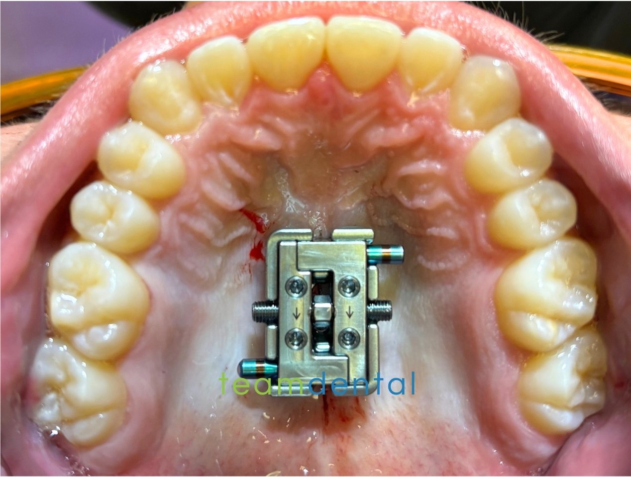6.1 MARPE Failure to Split, Molar Tipping and Over-Expansion Problems