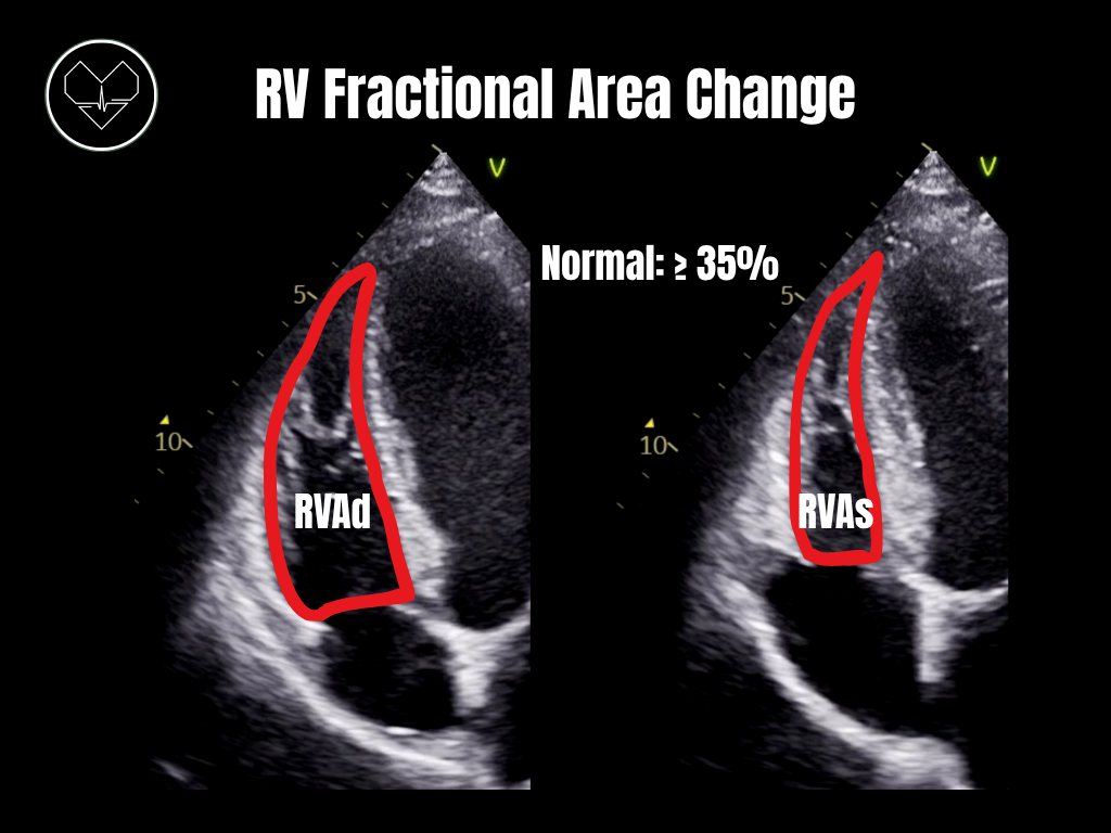Cor Pulmonale on Echo: What Sonographers Need to Know