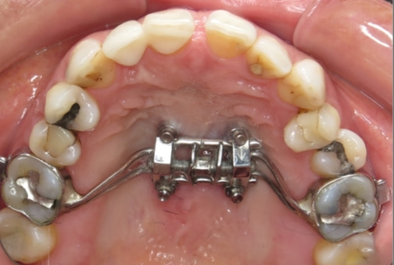 5.3 Top MARPE Devices Currently Available - JawHacks