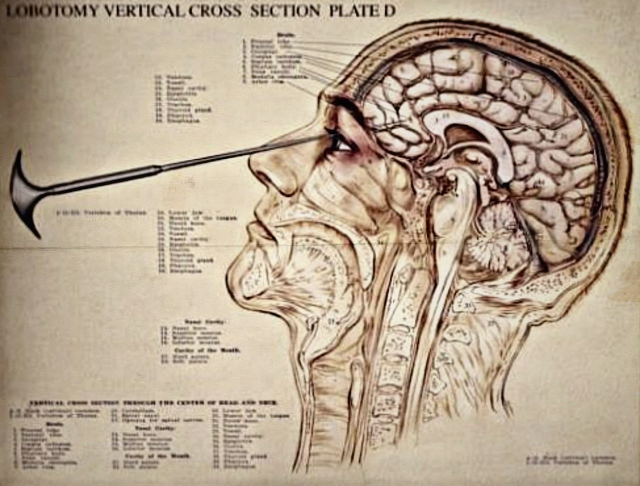 The Modern Day Lobotomy - by Torrance Stephens