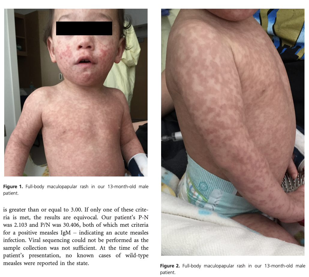Confirmed MMR Strain Measles: A Real Phenomenon with Unanswered Questions