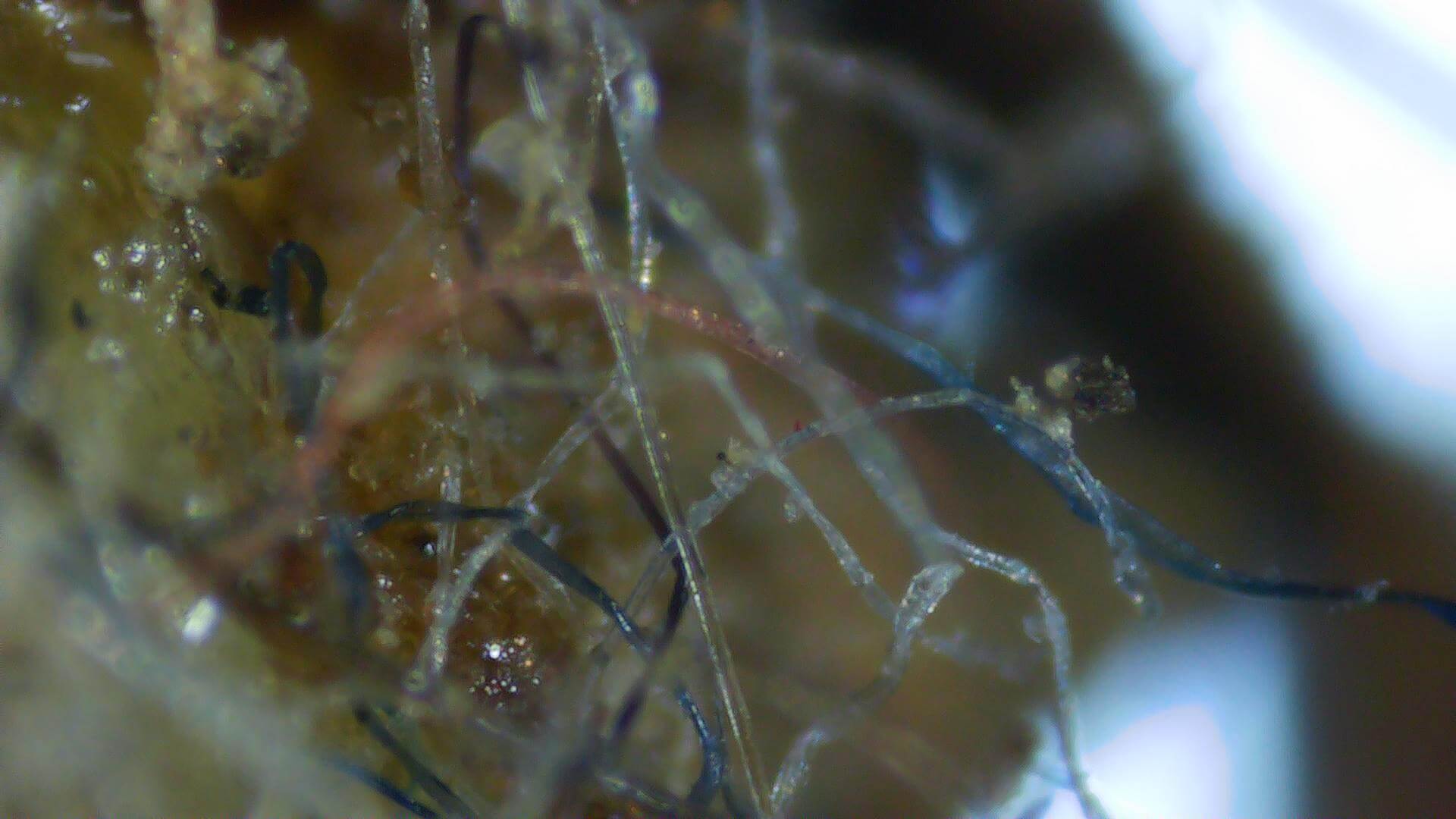 Morgellons Like Filament Tumor Found In Nasal Cavity With Insect ...