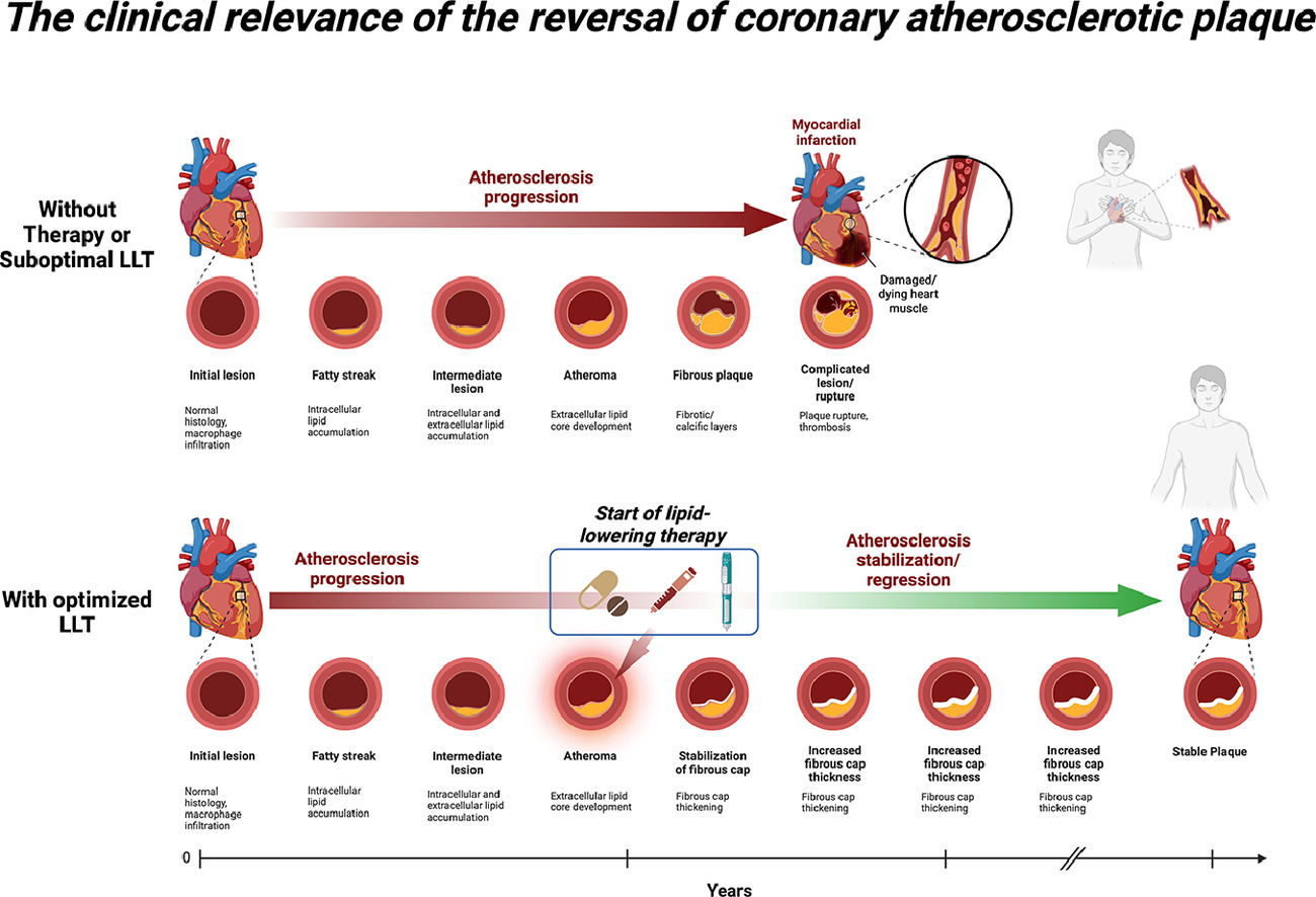 Understanding Atherosclerotic Cardiovascular Disease (ASCVD)
