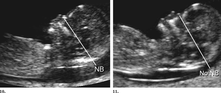 Fetal Ultrasound Soft Markers - Babies After 35
