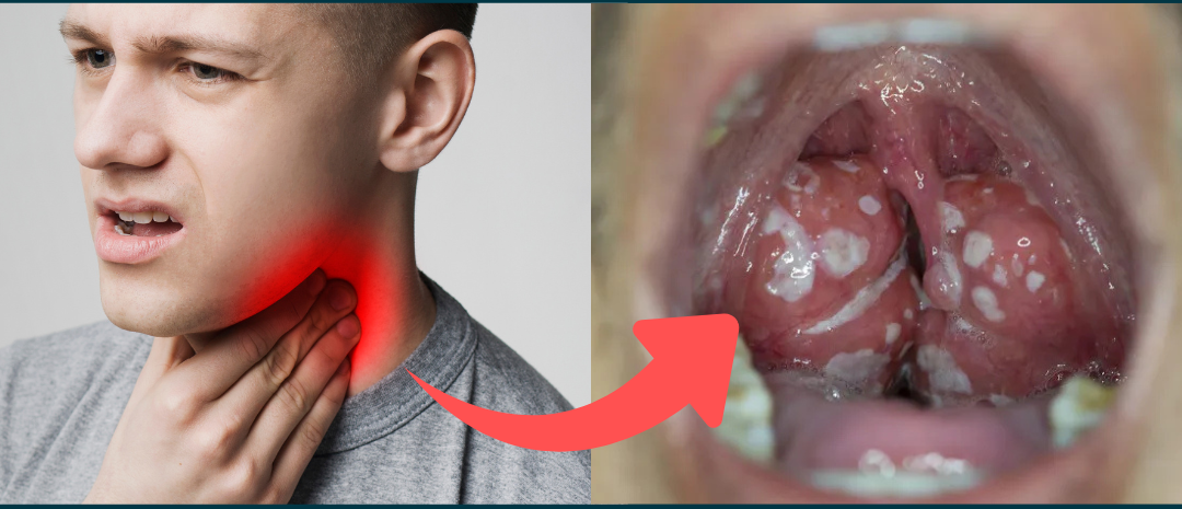 7 tratamentos para amigdalite - Mais Saúde Blue