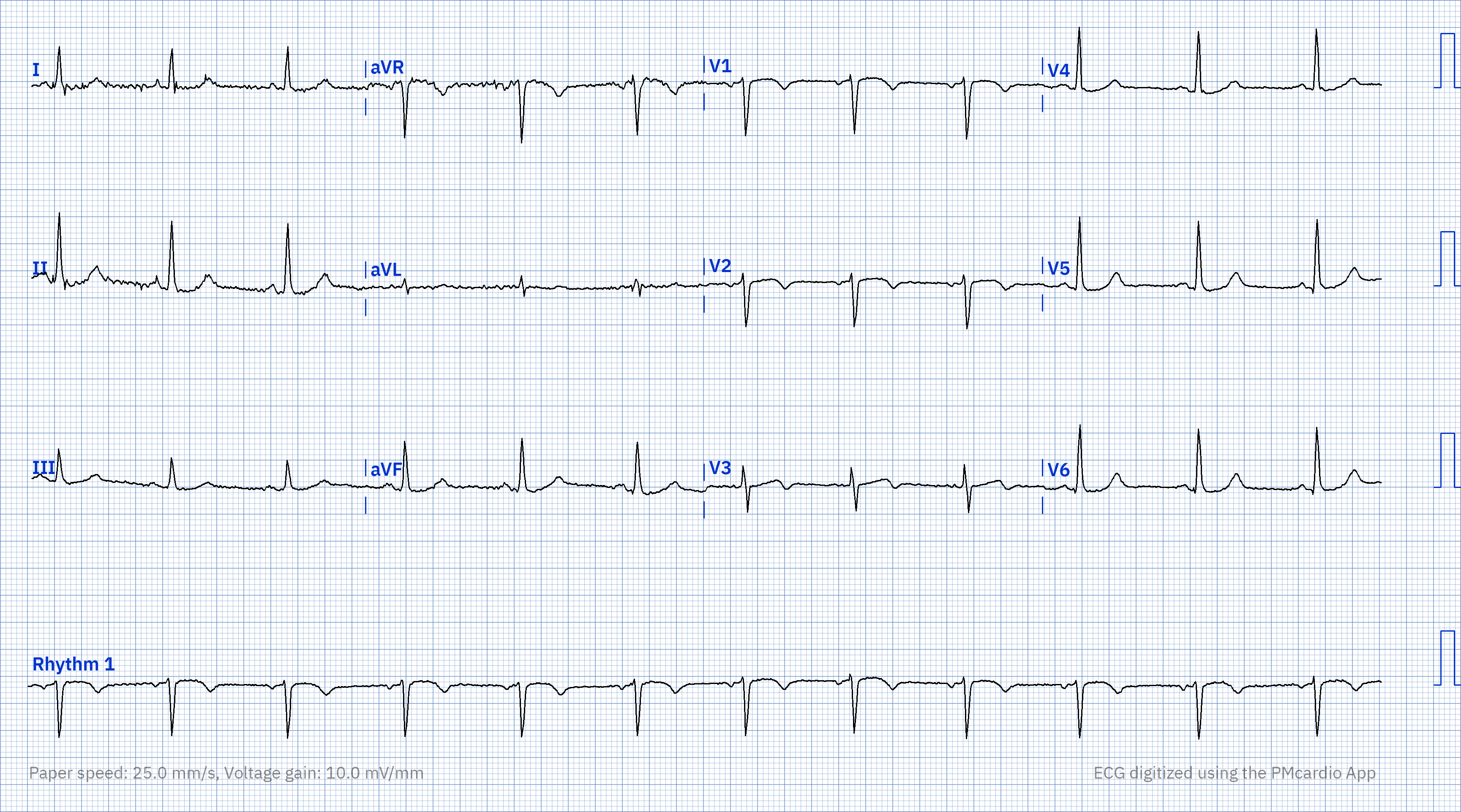 Dynamics of ACS: Top 12 ECGs of 2022 (Part 2)