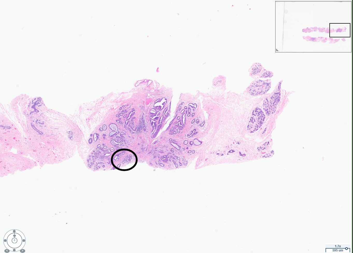 Radial Scar/Complex Sclerosing Lesion - by Chelsea Mehr, MD