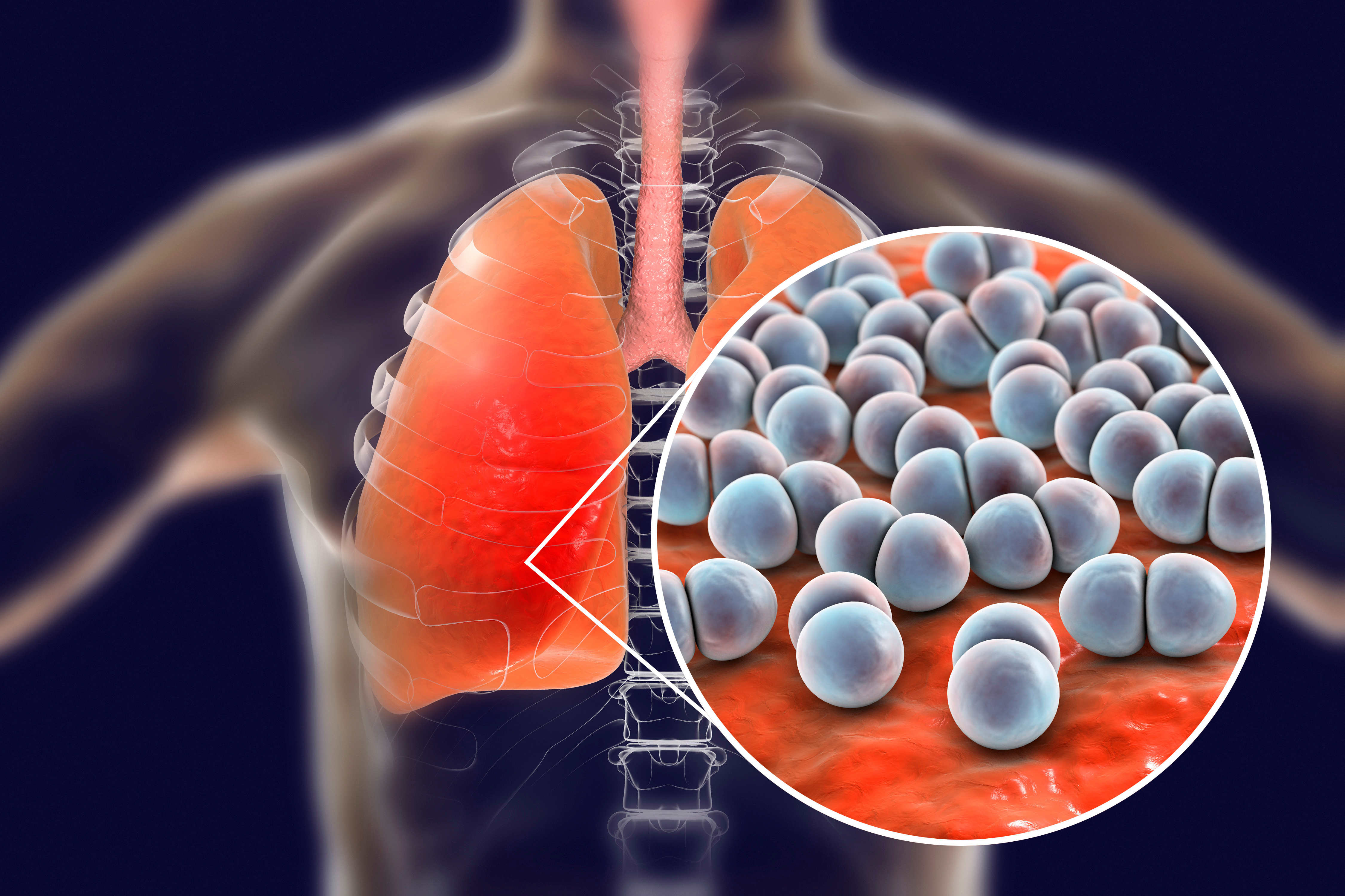 C-reactive protein to guide steroid use in severe community-acquired ...