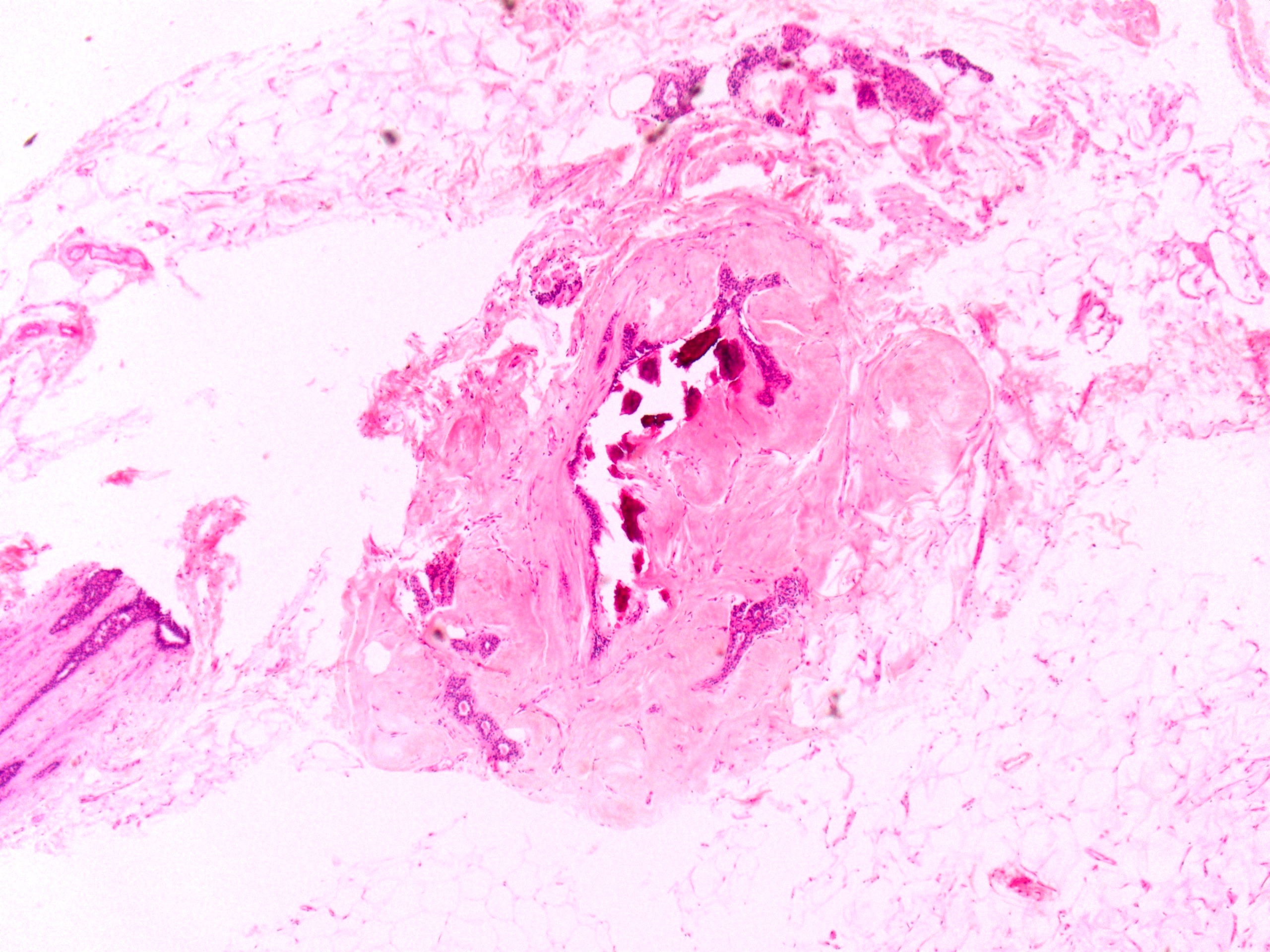 Fibroadenoma - by Chelsea Mehr, MD - The Path Princess