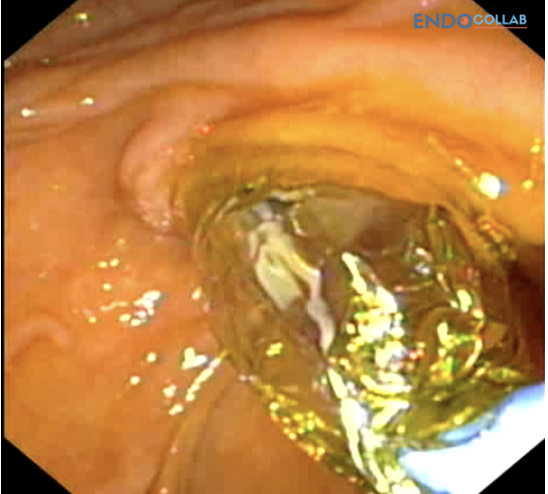 Endoscopic Management of Post-Sphincterotomy Bleeding: Eight Hemostatic ...