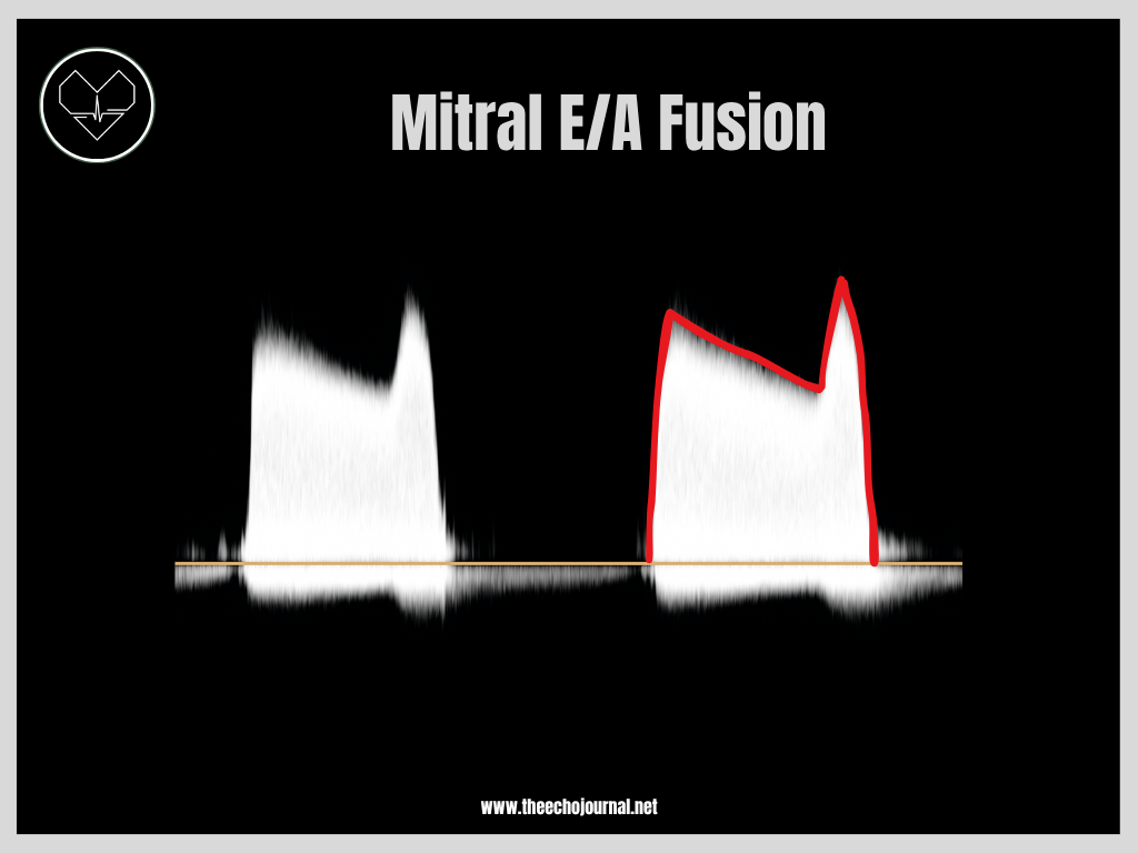 3 New Mitral Stenosis Findings - by Aram K.