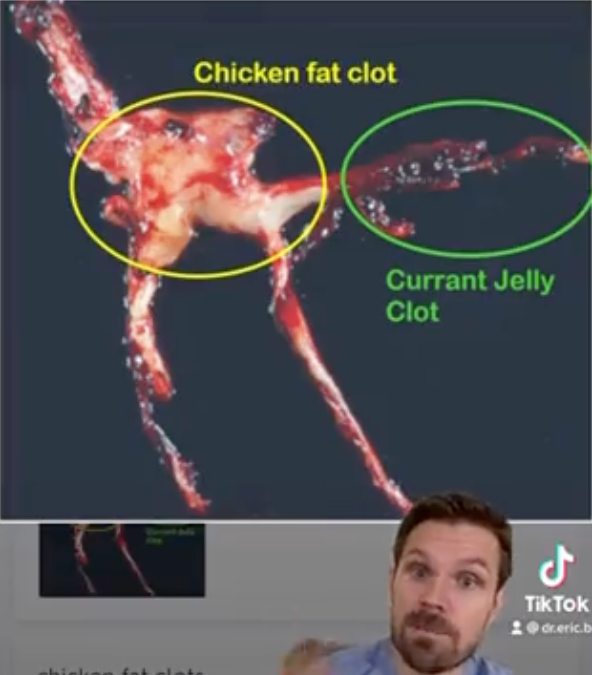 Is it just 'chicken fat' post-mortem clotting that the embalmers are ...
