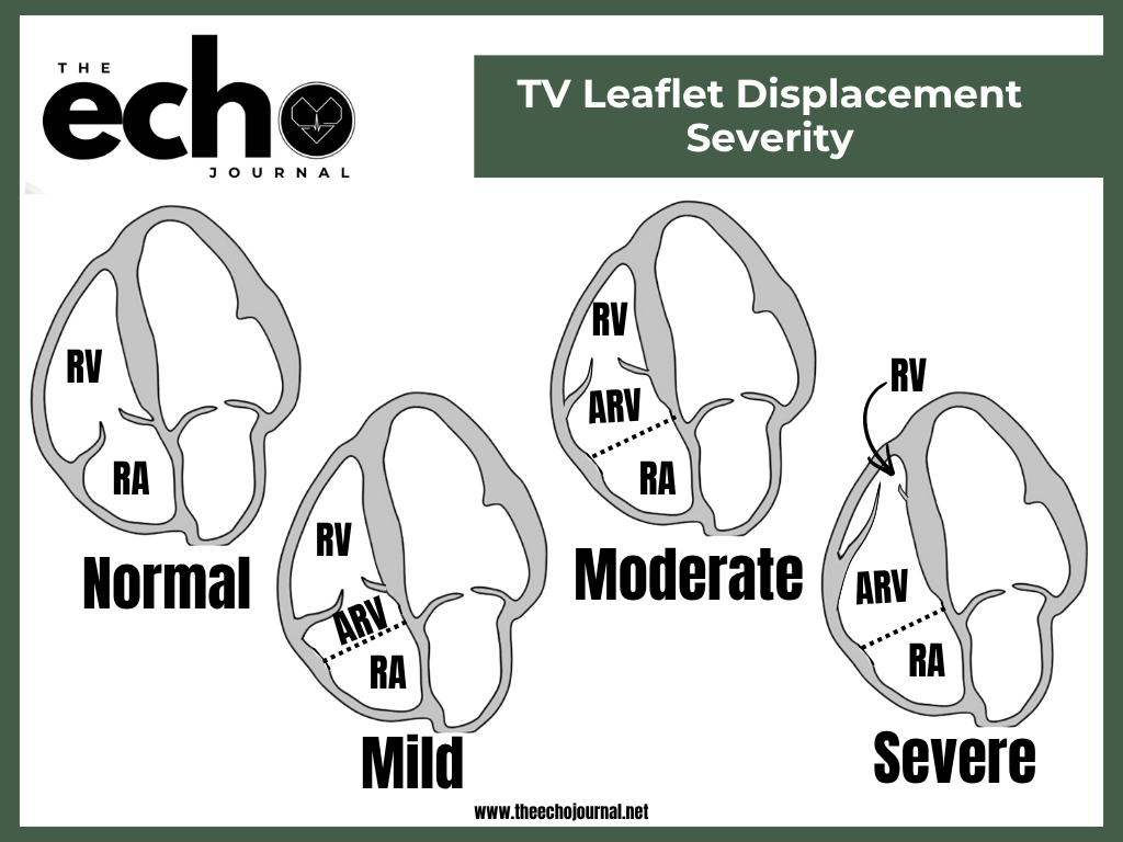 The Displaced Valve: Recognizing Ebstein's Anomaly on Echo