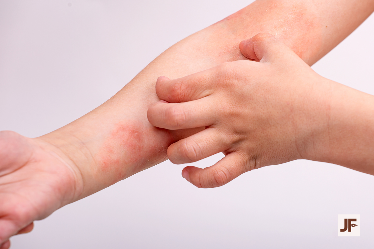 Clinician Insights: OX40-OX40L Signaling in Atopic Dermatitis