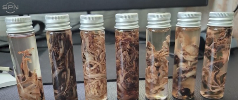 "CALAMARI CLOTS" - The Frightening Phenomenon of mRNA Bloodstreams