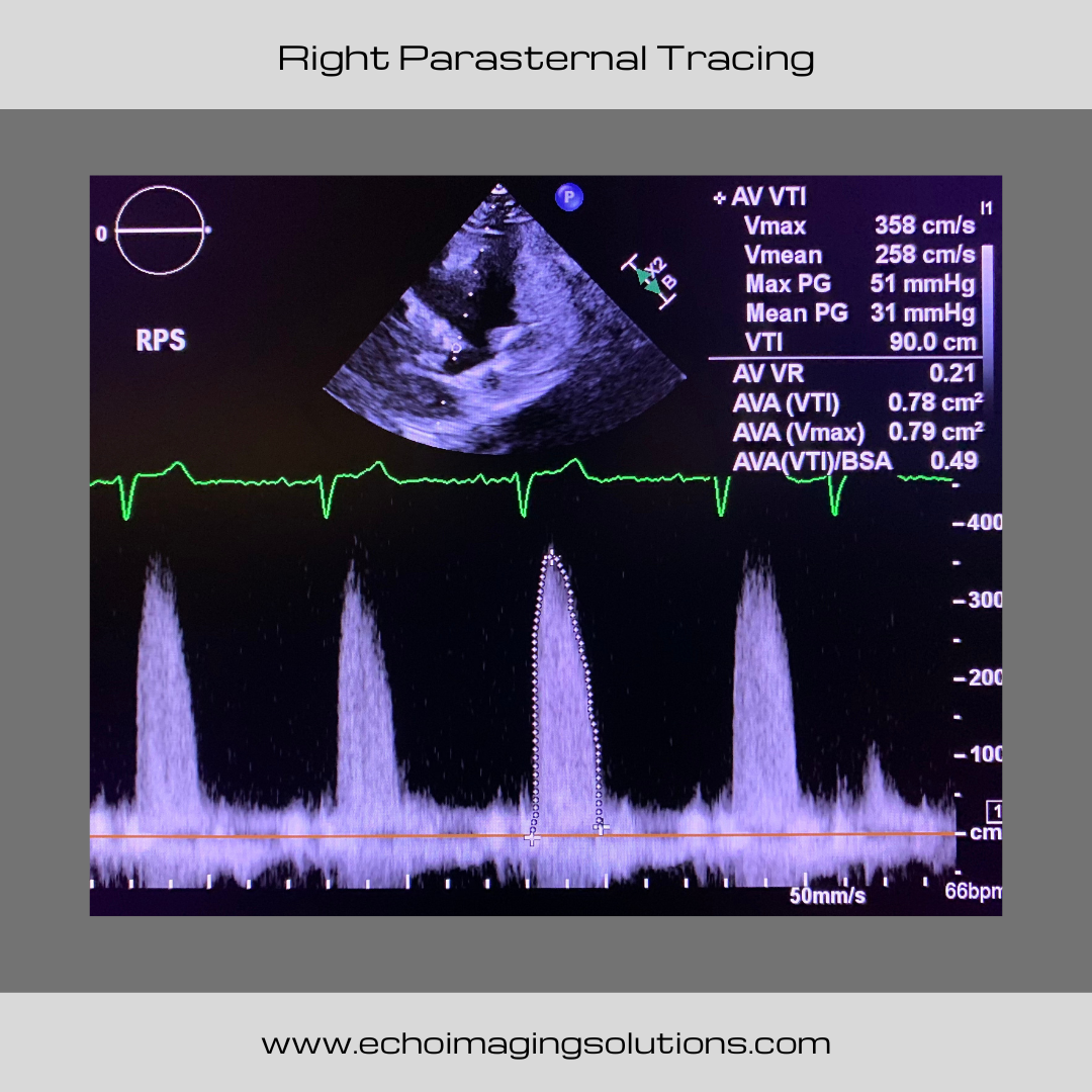 Aortic Stenosis: The Perfect TTE - by Aram K.