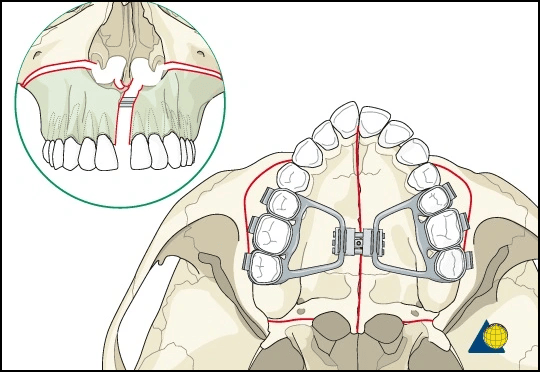 5.4 MARPE Surgical Assists - From Least to Most Invasive