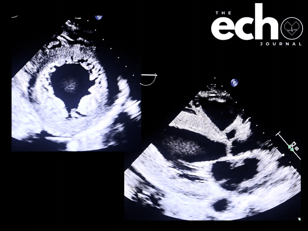 The Infiltrator: Recognizing Cardiac Amyloidosis on Echo