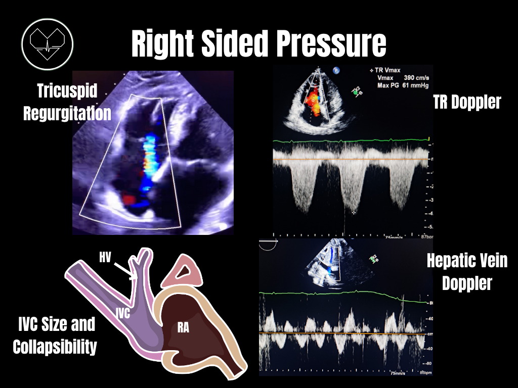 Cor Pulmonale on Echo: What Sonographers Need to Know