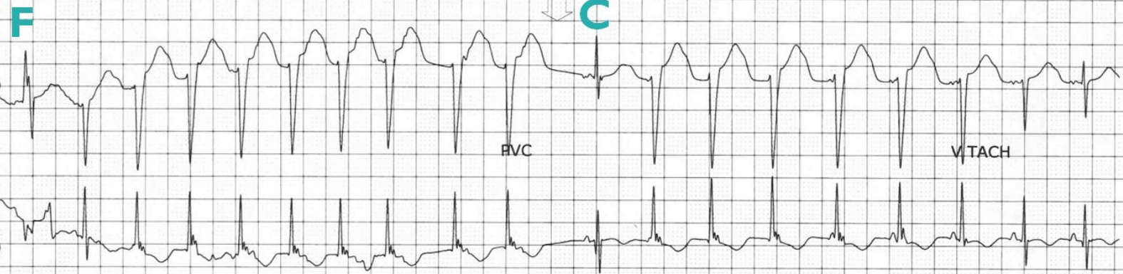 VTach or something else? - ECG Teaching Cases