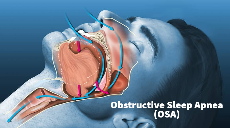 How Oxygen Levels Influence Sleep Apnea