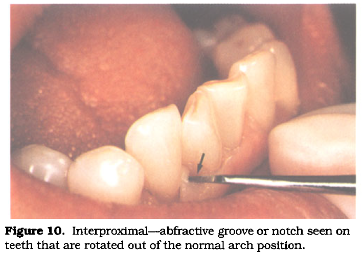 Abfractions: A New Classification of Hard Tissue Lesions of Teeth