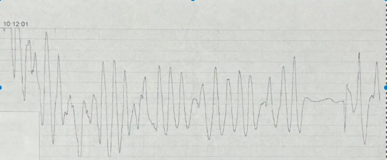 Atrial Fibrillation with a Rapid Ventricular Response Can Mimic VT