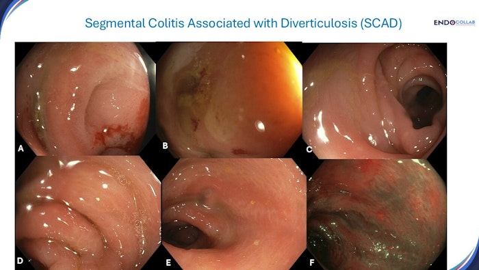 Segmental colitis associated diverticulosis (SCAD)