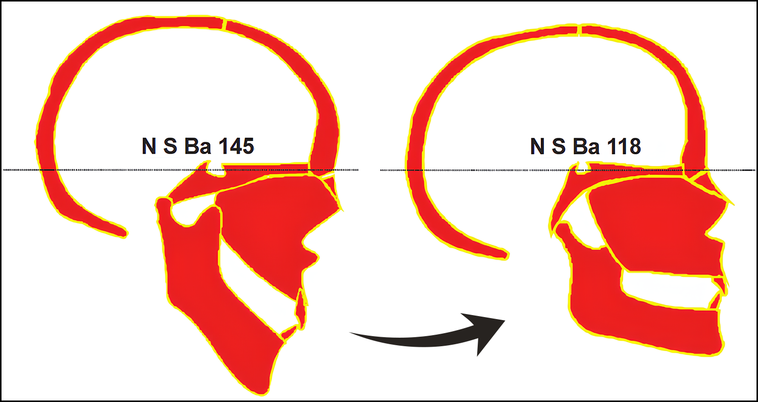 7.6 MARPE + Facemask for Protraction - by Ronald Ead
