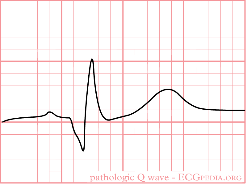 QRS complex nomenclature and morphology