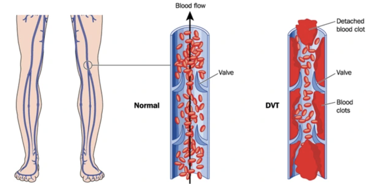 BLOOD CLOTS and ESTROGEN: The Facts