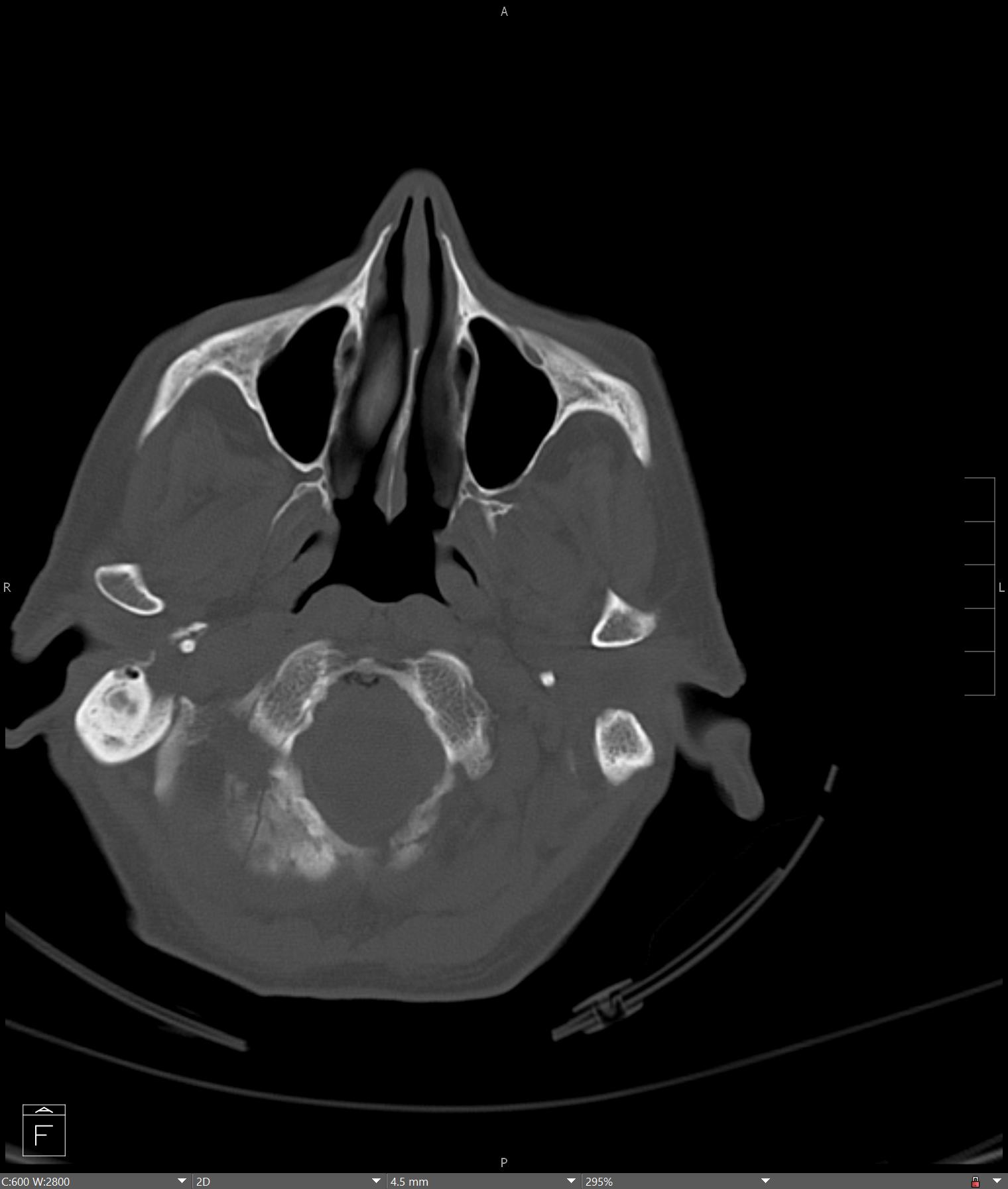 Occipital condyle fracture - by Alexander Baxter - RadNotes